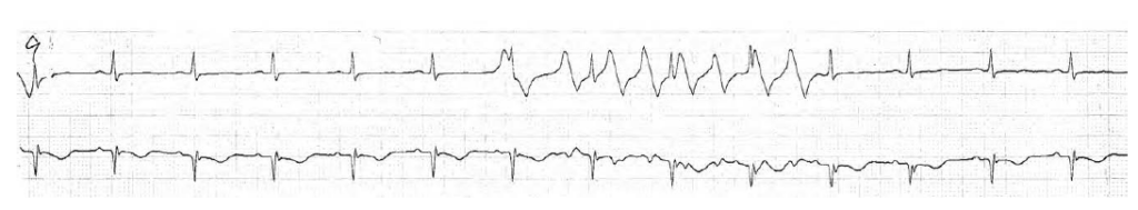 Ventricular Arrhythmias Worksheets - Medicine Digital Learning