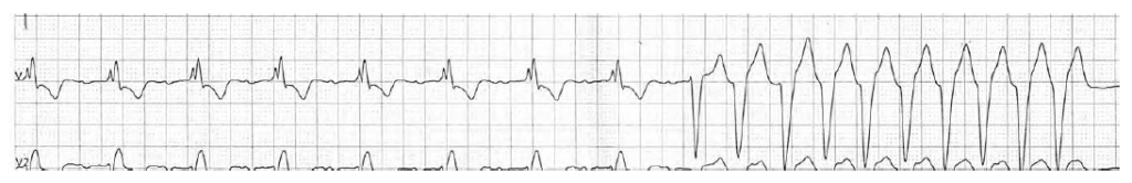 Ventricular Arrhythmias Worksheets - Medicine Digital Learning