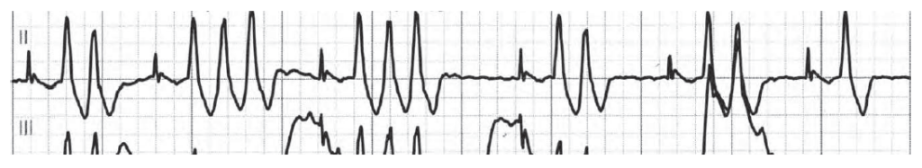 Ventricular Arrhythmias Worksheets - Medicine Digital Learning